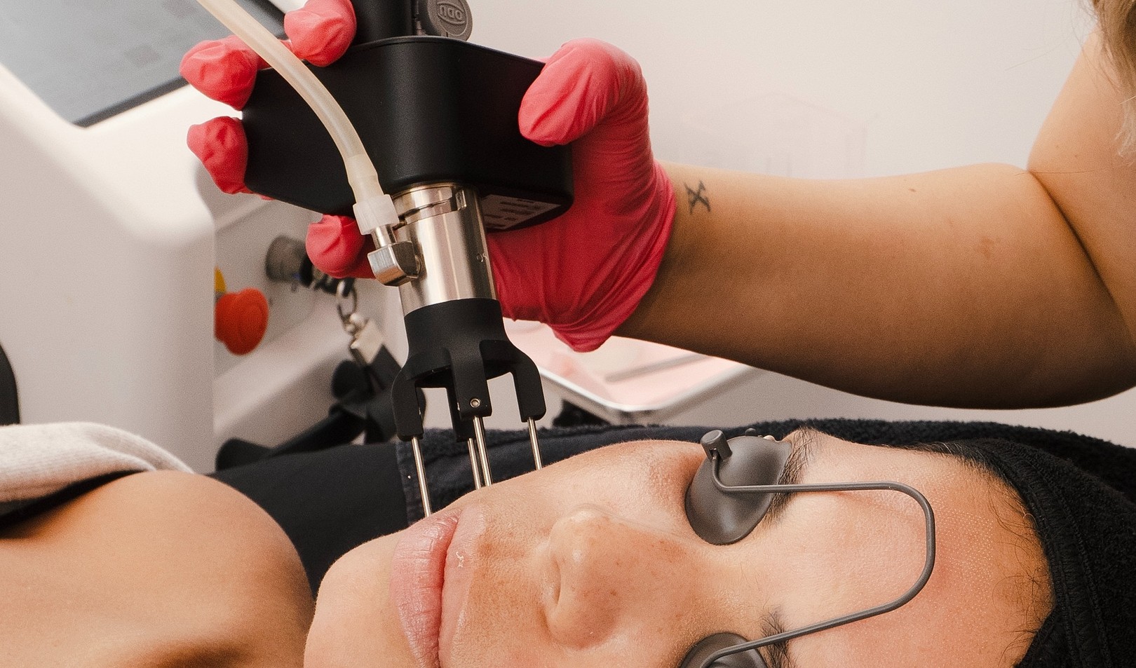 CO2 Laser Resurfacing St. Louis | Metro Medspa